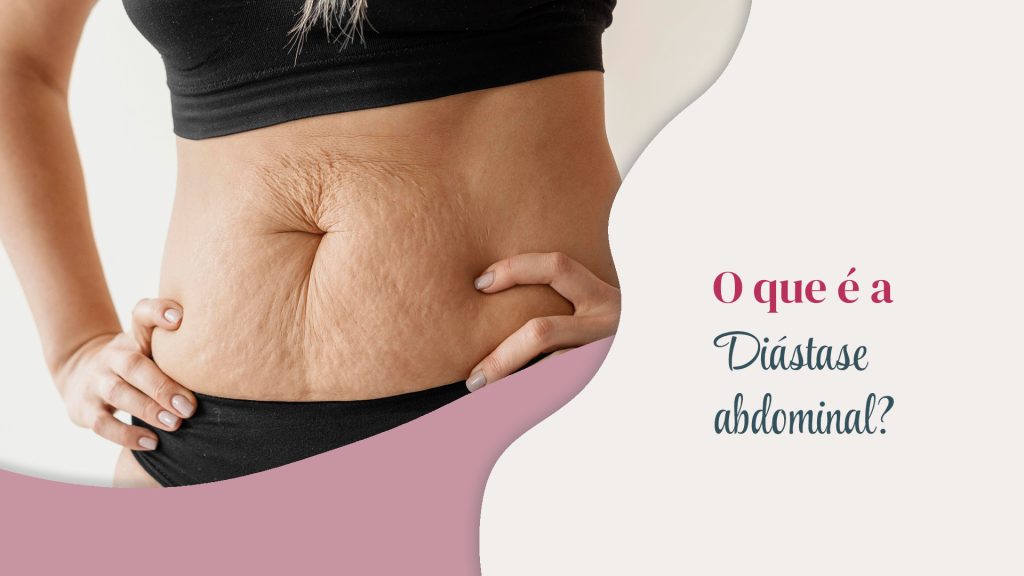 O que é a diástase abdominal - Fisio Mulher